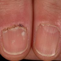 Scleroderma systemic Images - Altmeyers Encyclopedia - Department ...