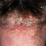 Scabies crustosa - Altmeyers Enzyklopädie - Fachbereich Dermatologie