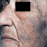 Scabies crustosa Bilder - Altmeyers Enzyklopädie - Fachbereich Dermatologie