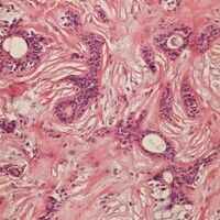 Syringom (overview) Images - Altmeyers Encyclopedia - Department ...