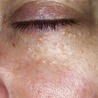 Syringom (Übersicht) Bilder - Altmeyers Enzyklopädie - Fachbereich ...