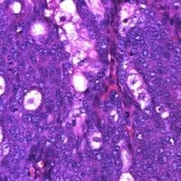 Sebaceoma Images - Altmeyers Encyclopedia - Department Dermatology