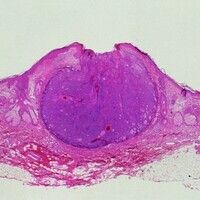 Sebaceoma Images - Altmeyers Encyclopedia - Department Dermatology