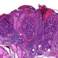 Sebaceoma Images - Altmeyers Encyclopedia - Department Dermatology
