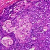 Sebaceoma Images - Altmeyers Encyclopedia - Department Dermatology