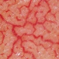 Teleangiectasia Images - Altmeyers Encyclopedia - Department Dermatology