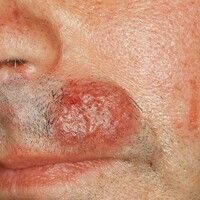 Tinea barbae Images - Altmeyers Encyclopedia - Department Dermatology