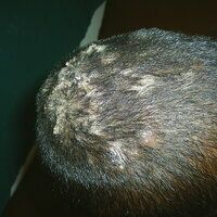Tinea capitis profunda Images - Altmeyers Encyclopedia - Department ...