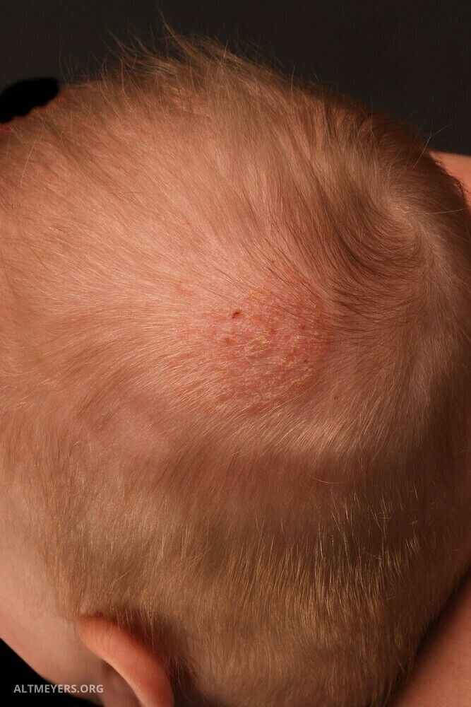Tinea Capitis Baby