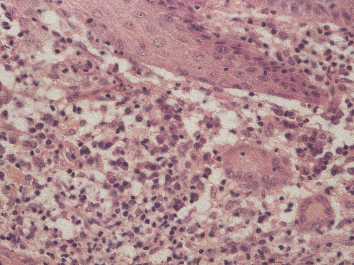 Sporothrix Schenckii Histology