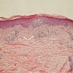 Spongiose - Altmeyers Enzyklopädie - Fachbereich Dermatologie