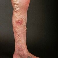 Stem vein varicosis Images - Altmeyers Encyclopedia - Department ...