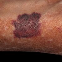 Steroid purpura Images - Altmeyers Encyclopedia - Department Dermatology