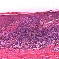 Nevus melanocytic halo-nevus Images - Altmeyers Encyclopedia ...