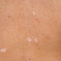 Nevus melanocytic halo-nevus Images - Altmeyers Encyclopedia ...