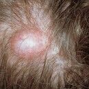 Ichthyosis hand, or foot - Altmeyers Encyclopedia - Department Dermatology