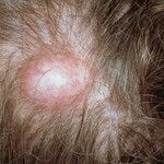 Trichilemmalzyste - Altmeyers Enzyklopädie - Fachbereich Dermatologie