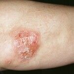 Tuberculosis cutis luposa - Altmeyers Encyclopedia - Department Dermatology