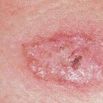 Tuberculosis cutis verrucosa - Altmeyers Encyclopedia - Department ...