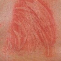 Urticaria factitia Bilder - Altmeyers Enzyklopädie - Fachbereich ...