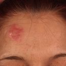 Pigment incontinence - Altmeyers Encyclopedia - Department Dermatology