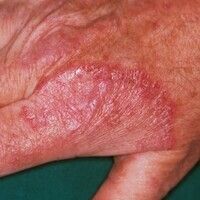 Tinea manus Bilder - Altmeyers Enzyklopädie - Fachbereich Dermatologie