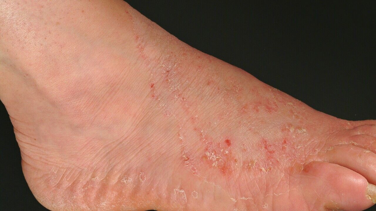 Vesicular Tinea Pedis