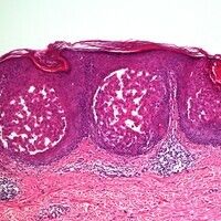 Keratose seborrhoische (Übersicht) Bilder - Altmeyers Enzyklopädie ...