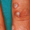 Verruca filiformis - Altmeyers Enzyklopädie - Fachbereich Dermatologie