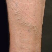 Varice Images - Altmeyers Encyclopedia - Department Vascular medicine