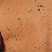 Keratose seborrhoische (Übersicht) Bilder - Altmeyers Enzyklopädie ...