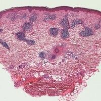 Lymphocytic infiltration of the skin Bilder - Altmeyers Enzyklopädie ...