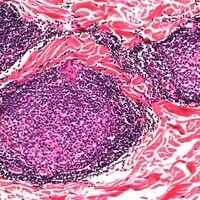 Primary cutaneous follicular lymphoma Images - Altmeyers Encyclopedia - Department Dermatology