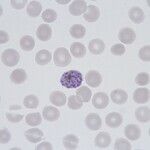 Malaria - Altmeyers Enzyklopädie - Fachbereich Dermatologie