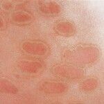 Woronoff ring - Altmeyers Encyclopedia - Department Dermatology