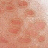 Woronoff-Ring Bilder - Altmeyers Enzyklopädie - Fachbereich Dermatologie