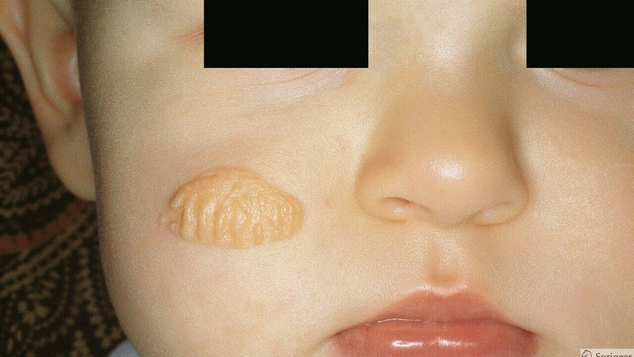 Juvenile Xanthogranuloma