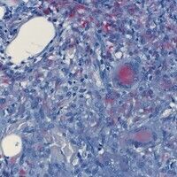 Xanthogranulom, nekrobiotisches mit Paraproteinämie Images - Altmeyers ...