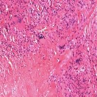 Xanthogranulom nekrobiotisches mit Paraproteinämie Bilder - Altmeyers ...