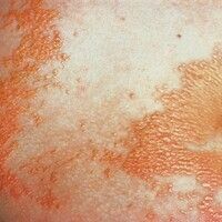 Xanthomatosis generalized plane Images - Altmeyers Encyclopedia ...