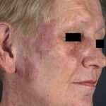 Xanthogranulom, nekrobiotisches mit Paraproteinämie - Altmeyers ...