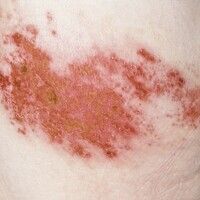 Zoster Images - Altmeyers Encyclopedia - Department Dermatology