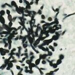 Candida-Sepsis - Altmeyers Enzyklopädie - Fachbereich Innere Medizin