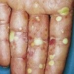 Pustulosis palmaris et plantaris - Altmeyers Encyclopedia - Department ...