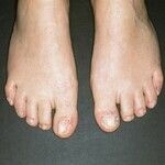 Koenen tumour - Altmeyers Encyclopedia - Department Dermatology