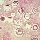 Candida mycosis, generalized of the skin - Altmeyers Encyclopedia ...