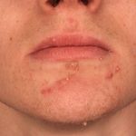 Generalized verrucosis - Altmeyers Encyclopedia - Department Dermatology