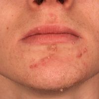 Generalized verrucosis Images - Altmeyers Encyclopedia - Department ...