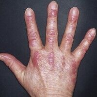 Gottron-Papeln Images - Altmeyers Encyclopedia - Department Dermatology