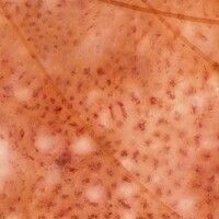 Reflected light microscopy, perivascular melanophages Bilder ...